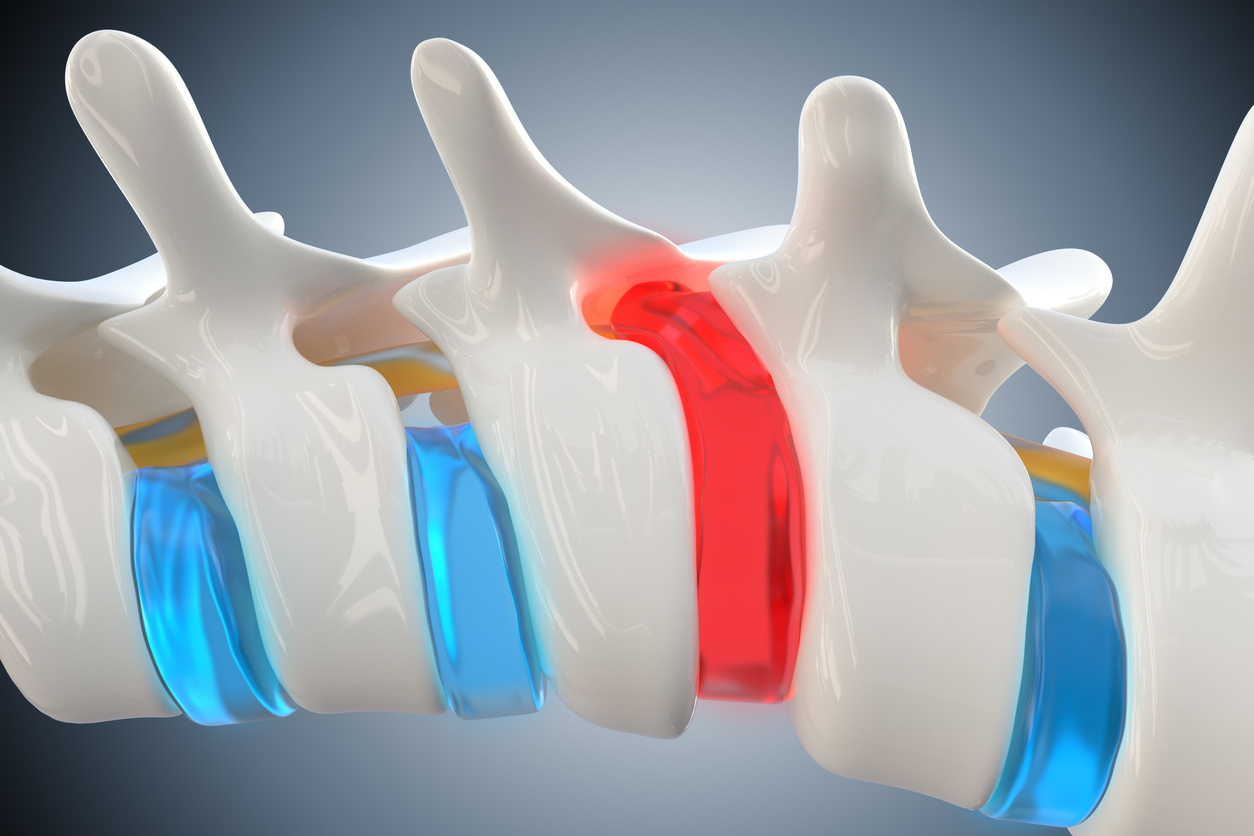 Disc Bulges, Chiropractic Care and Spinal Decompression - Apex Chiropractic